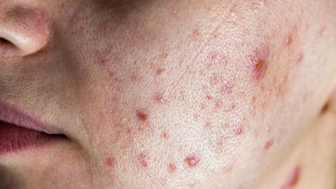 Quelle 8 maladies de peau courantes avec le diabète ? - Life5yance : c ...